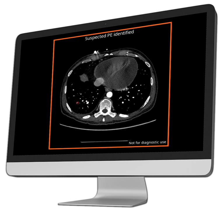 Avicenna.AI | AI Radiology - Opportunistic Findings
